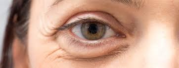 Donkere kringen, oogwallen en kraaienpootjes rond de ogen verminderen